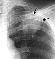 (EN) – Glossary of Terms for Thoracic Imaging | Fleischner Society – 📚 ...