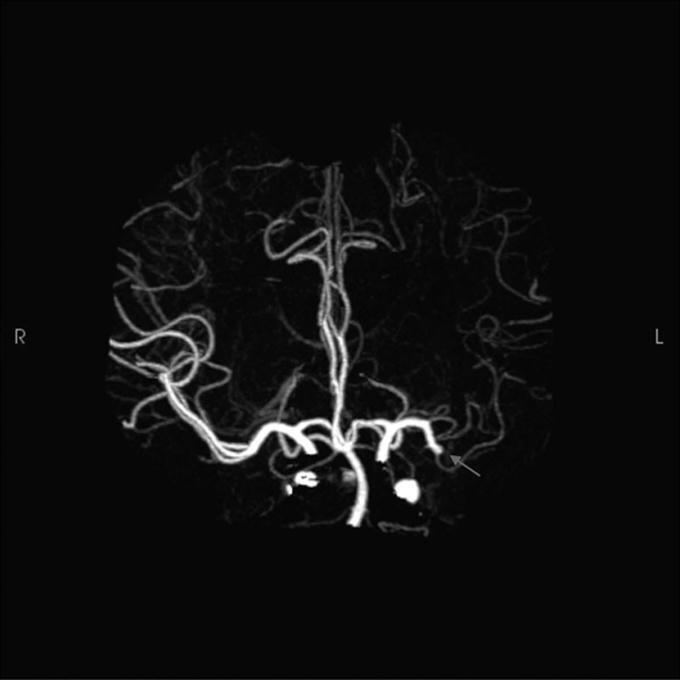 Management of Acute Ischemic Stroke | Neurovasc...