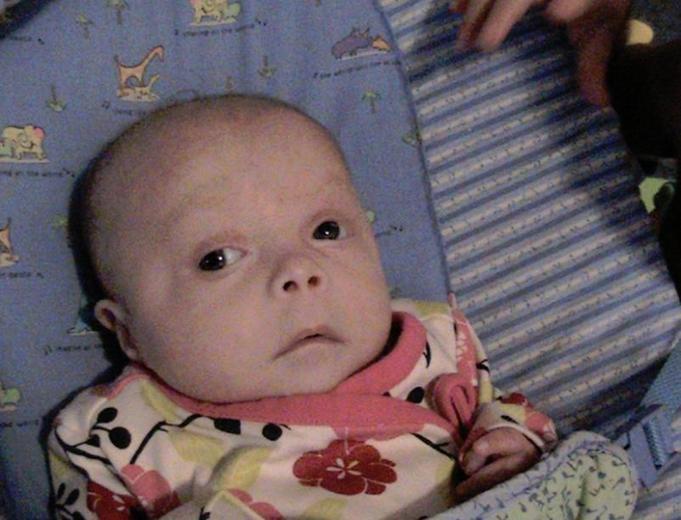 Tetrasomy 18p Syndrome Life Expectancy | Family...