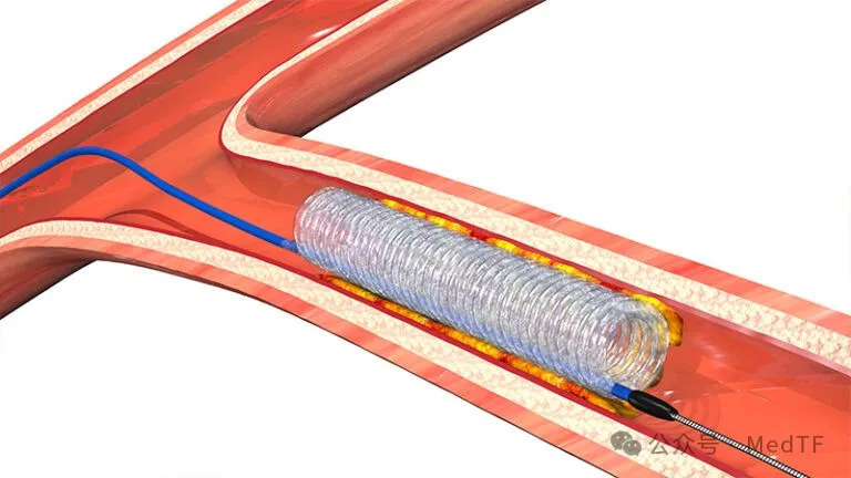 PCI helical hemostasis cell sac | Interventiona...