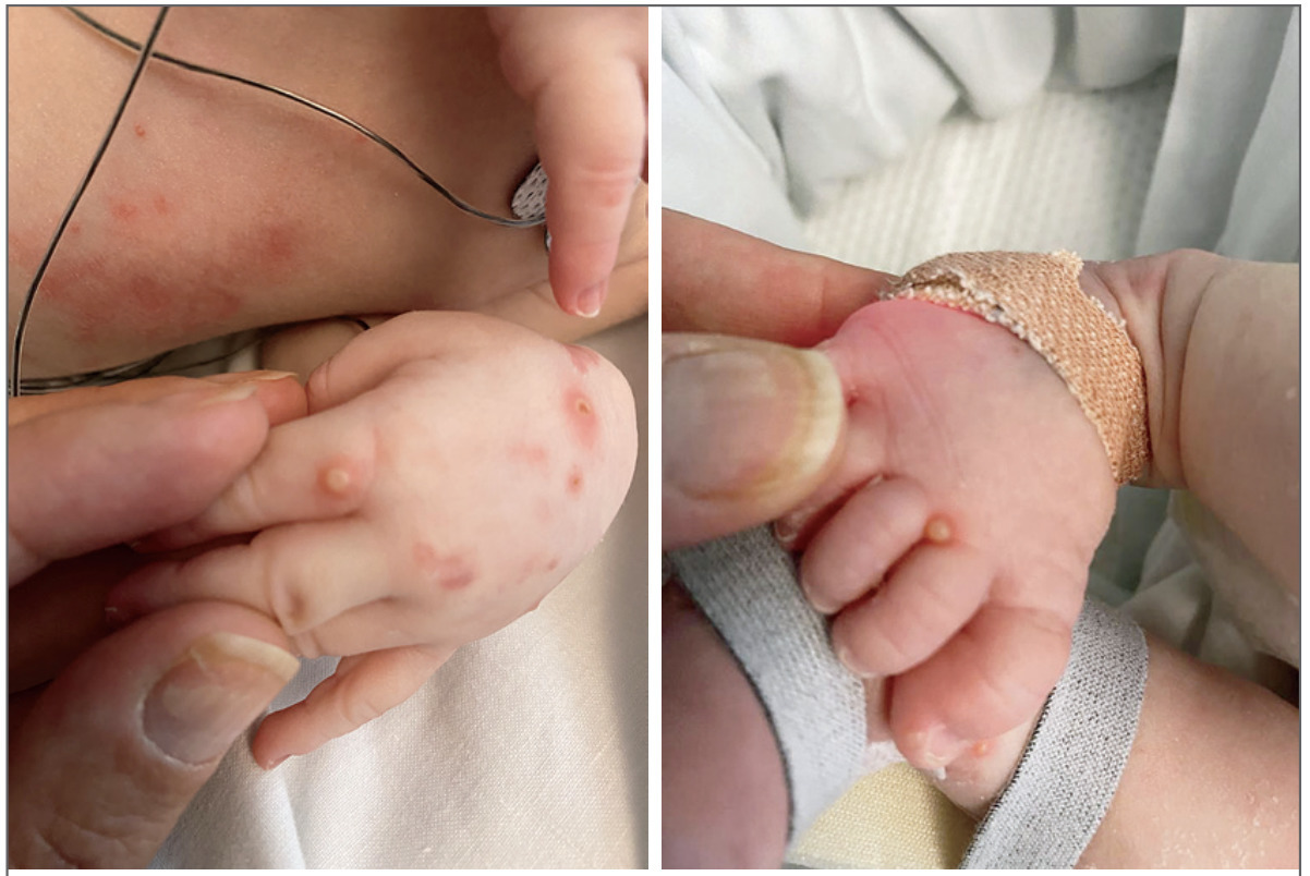 Neonatal Monkeypox Virus Infection | NEJM | Vir...