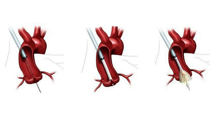 In Cardiogenic Shock, Edge-to-Edge Mitral Valve...