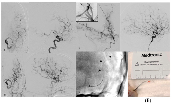 Enterprise stent for the treatment of symptomat...
