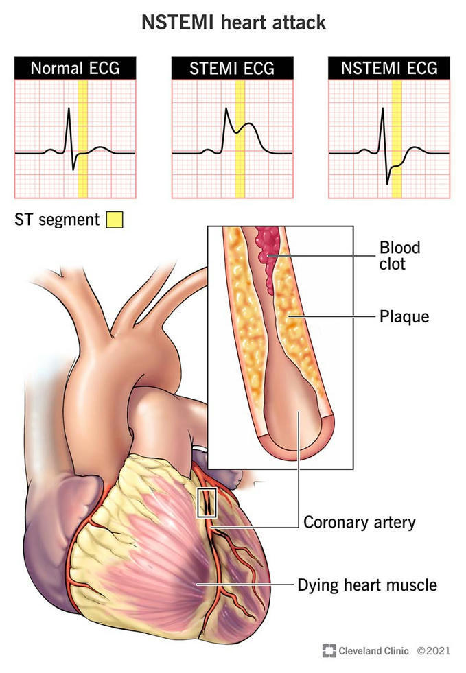 Nstemi Causes Symptoms Diagnosis Treatment