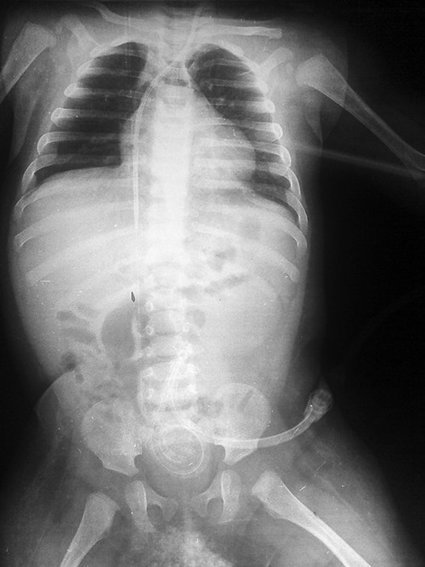 Catheter Access Management for Acute Peritoneal...