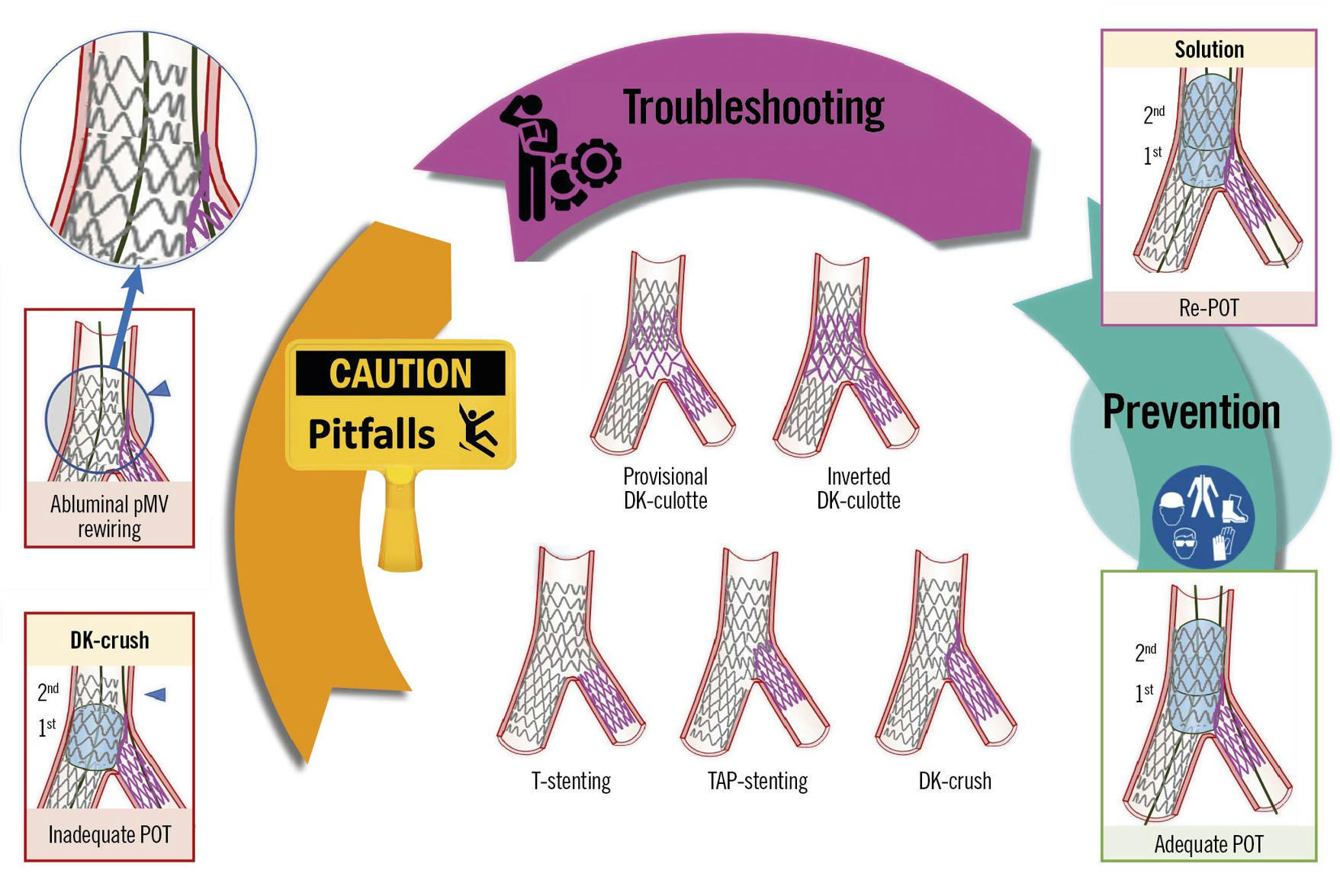Treatment of coronary bifurcation lesions, part...