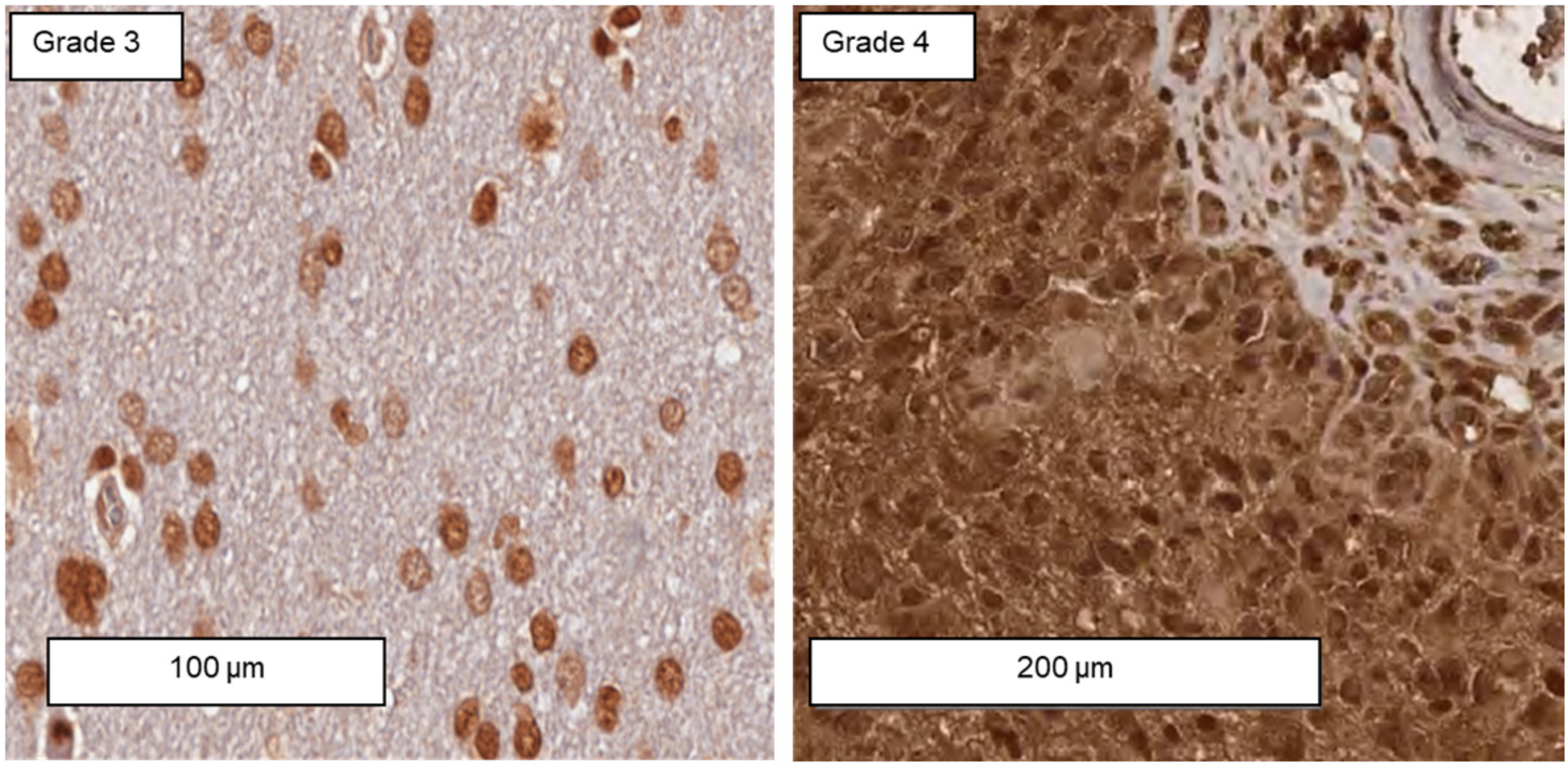 Biomarkers in Adult-Type Diffuse Gliomas: Eleva...