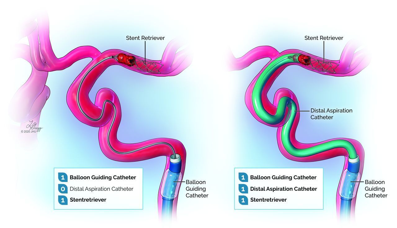 Combined balloon guide catheter, aspiration cat...