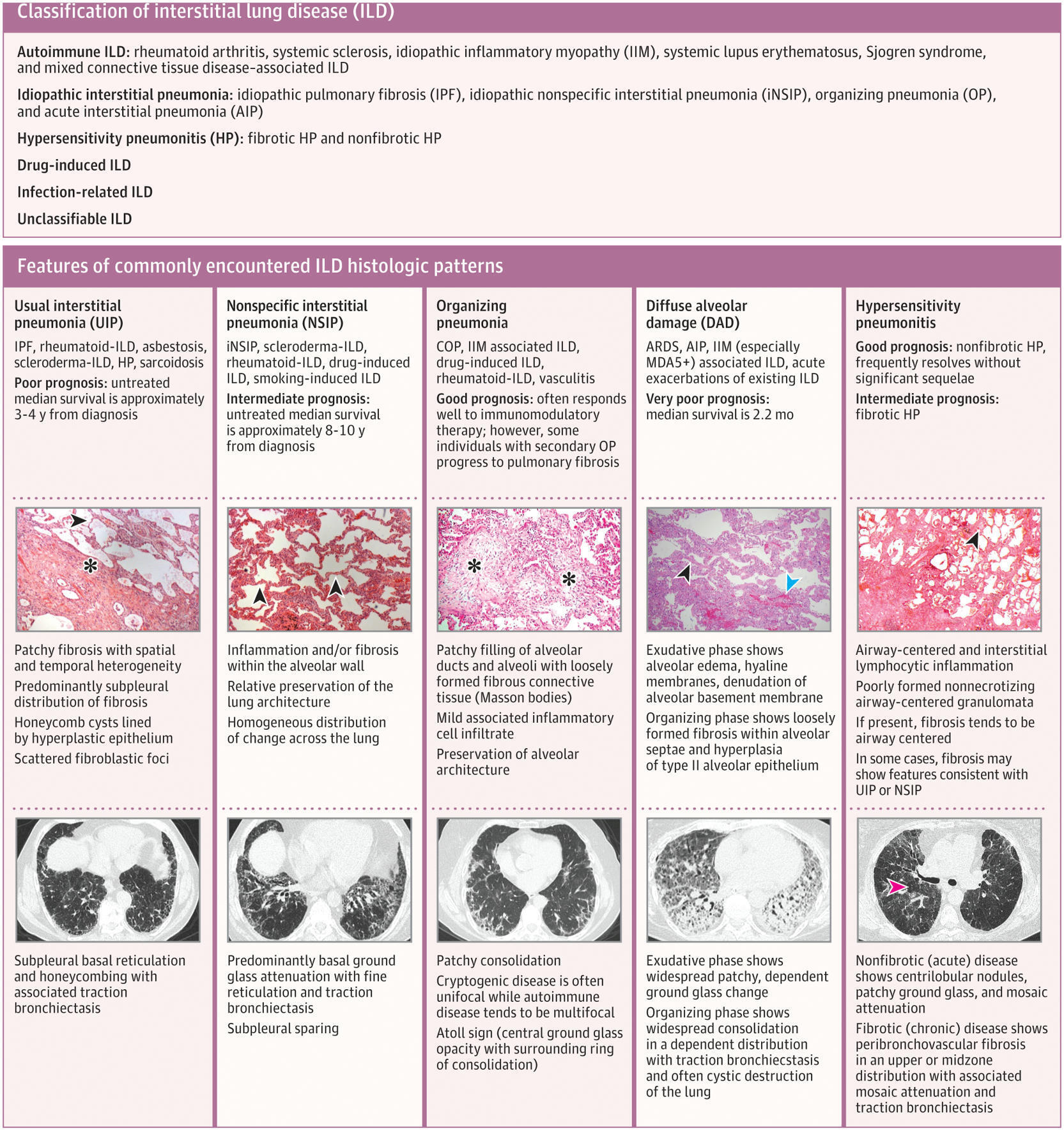 Interstitial Lung Disease: A Review | Pulmonary...