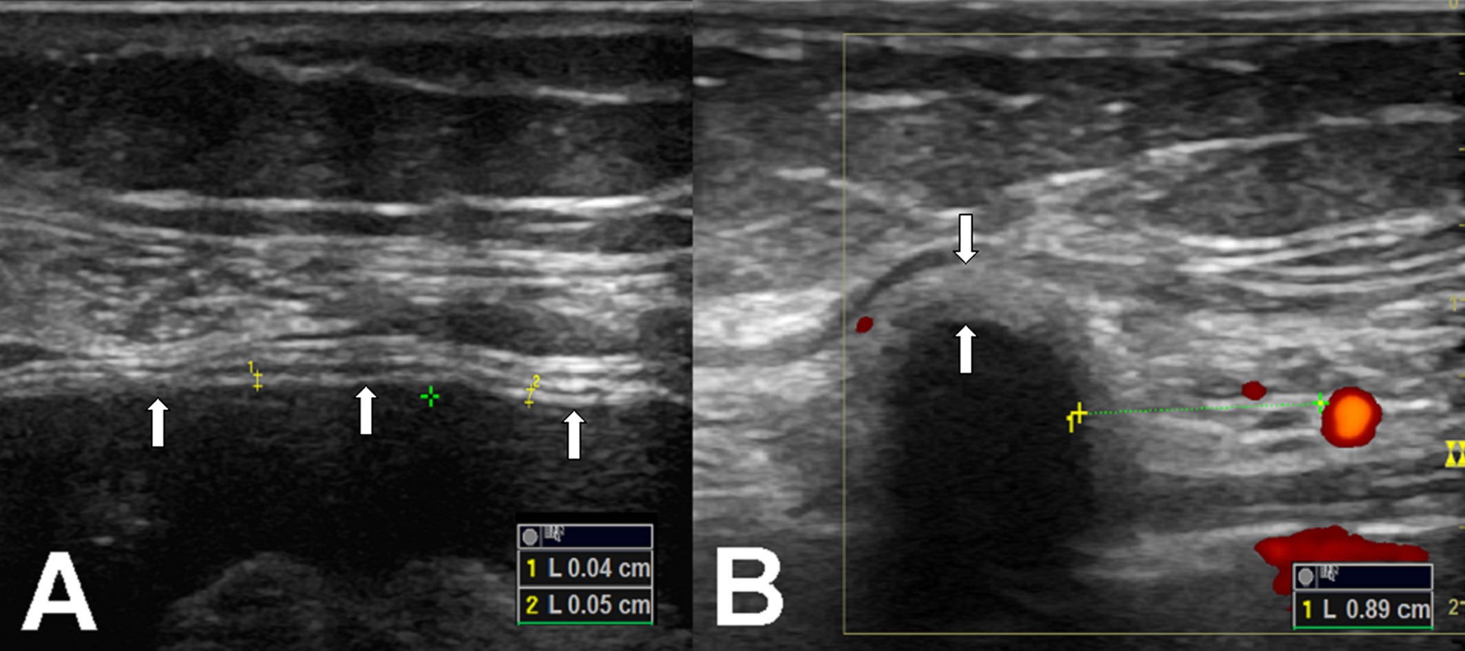 The Underrated Role of Ultrasound in Peritoneal...
