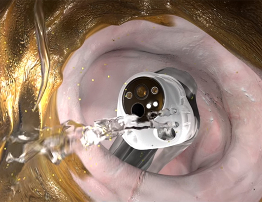 Pure-Vu Pre-Colonoscopy Colon Cleansing System ...