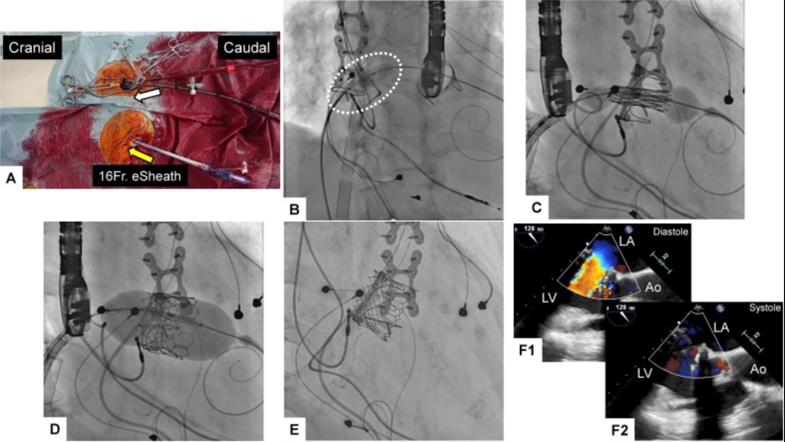 Percutaneous transseptal transcatheter mitral v...