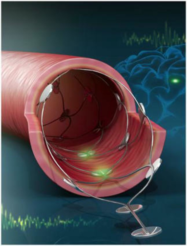 Neurostimulation Devices for the Treatment of N...