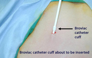 Hickman* / Broviac* / Leonard* Catheters | Cent...