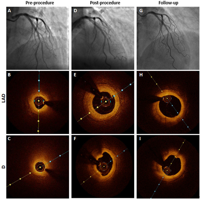 Randomized Pilot Study to Compare DCB-Based ver...