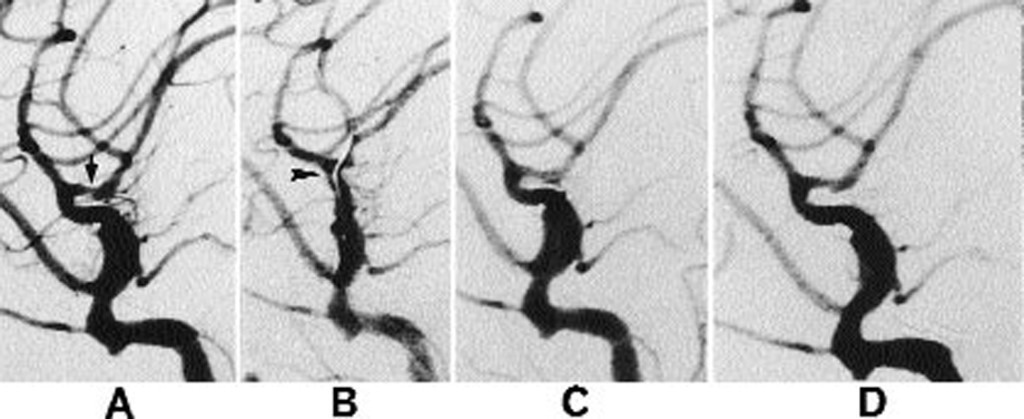 Intracranial Percutaneous Transluminal Angiopla...
