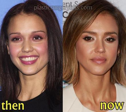 'Jessica Alba Lip Injection' in Plastic surgery and celebrity | Scoop.it