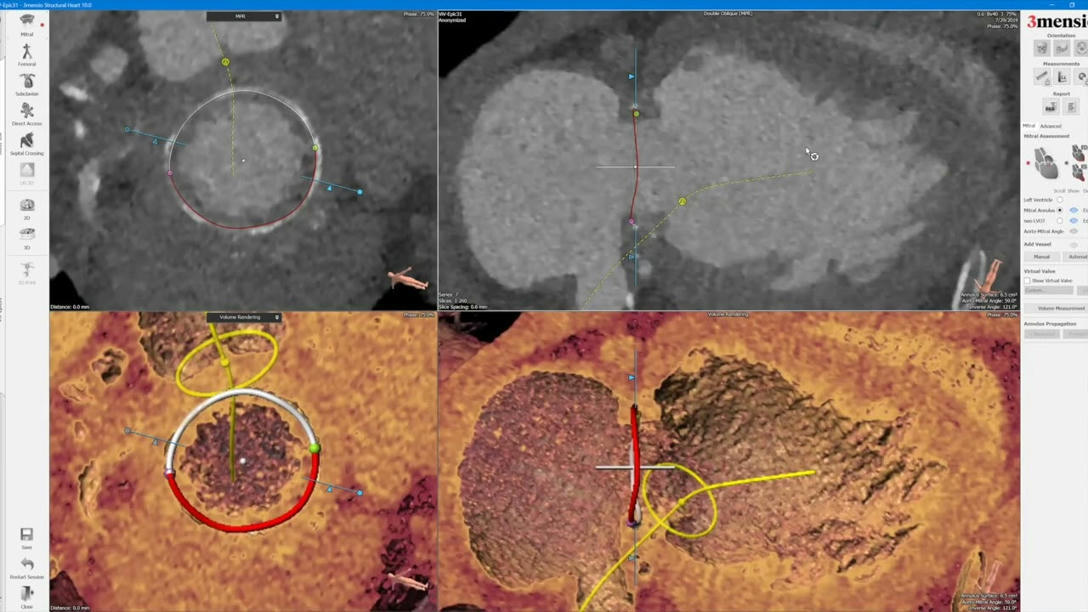 3Mensio CT Pre-case Planning: Mitral Valve-in-V...