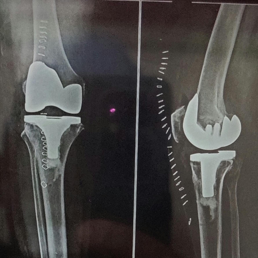 Robotic knee replacement surgery we started Rob...