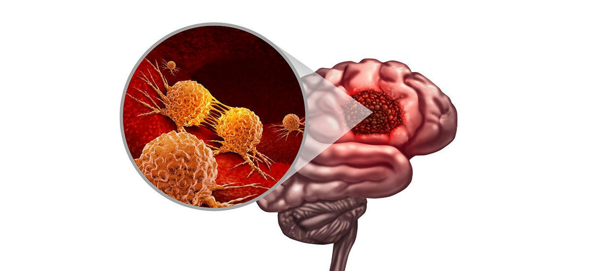 What Is Glioblastoma and Why Is It So Deadly?