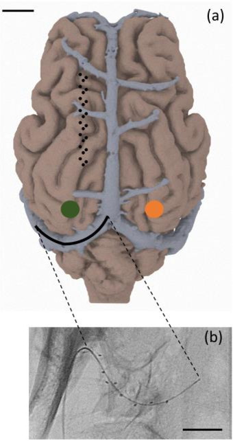 Cortical Brain Stimulation with Endovascular El...