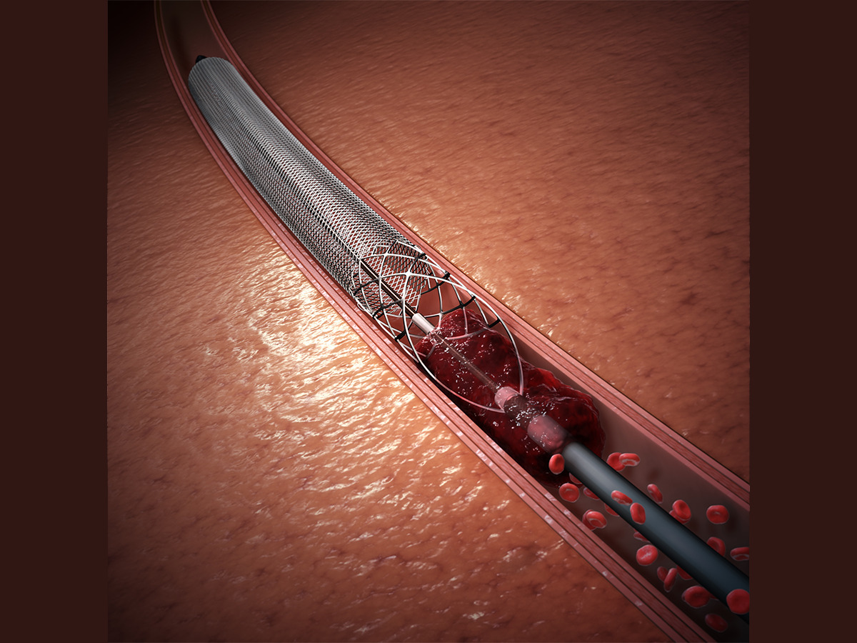 Inari Medical Updates Use Instructions for Clot...